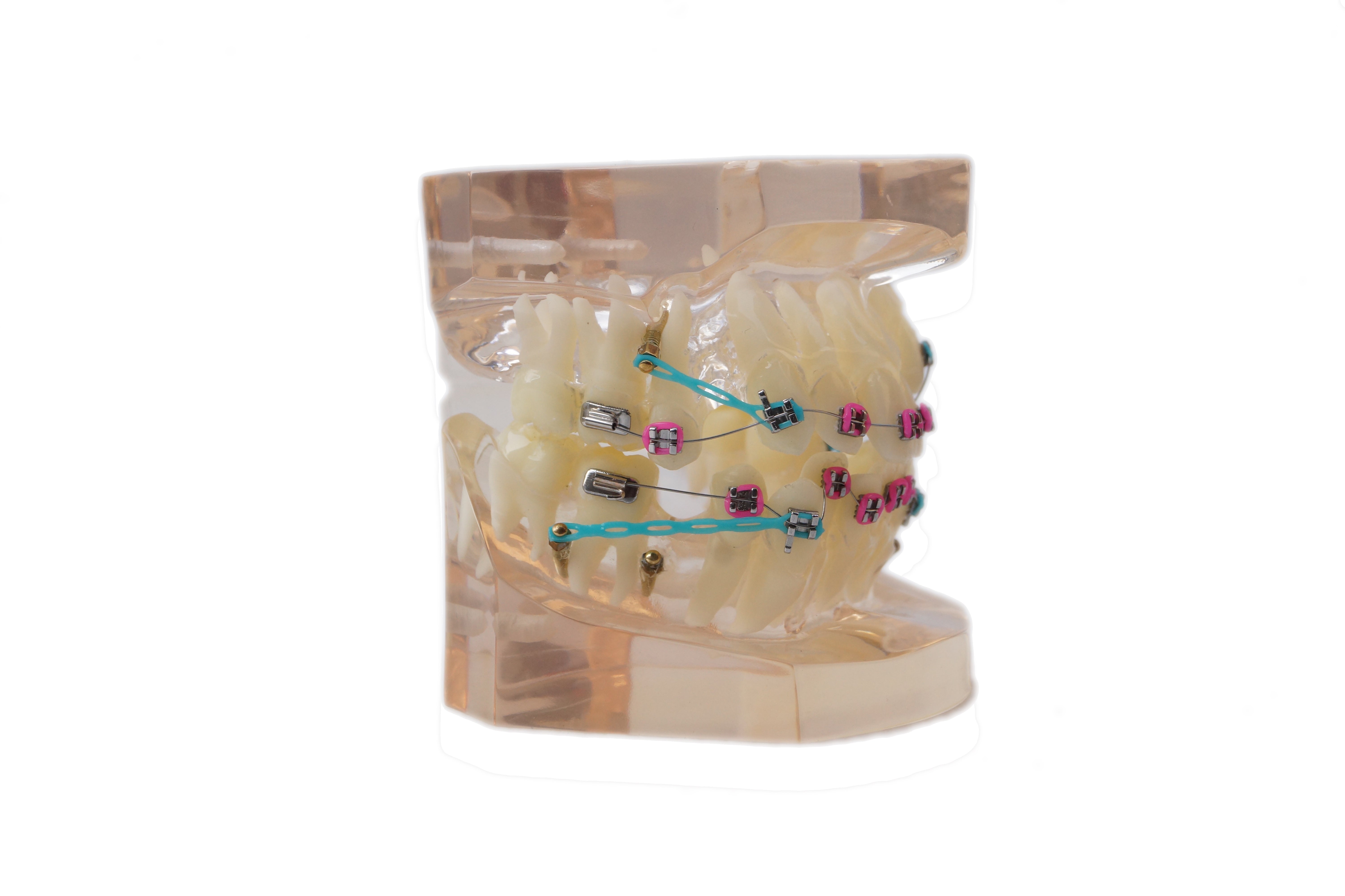 Standard Orthodontic Tooth Model – Full Dentition with Brackets, Archw ...